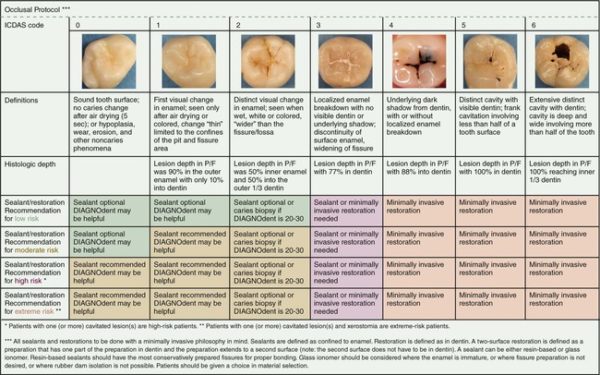 Diagnostyka próchnicy – System ICDAS | lek. dent. Tomasz Łukasik
